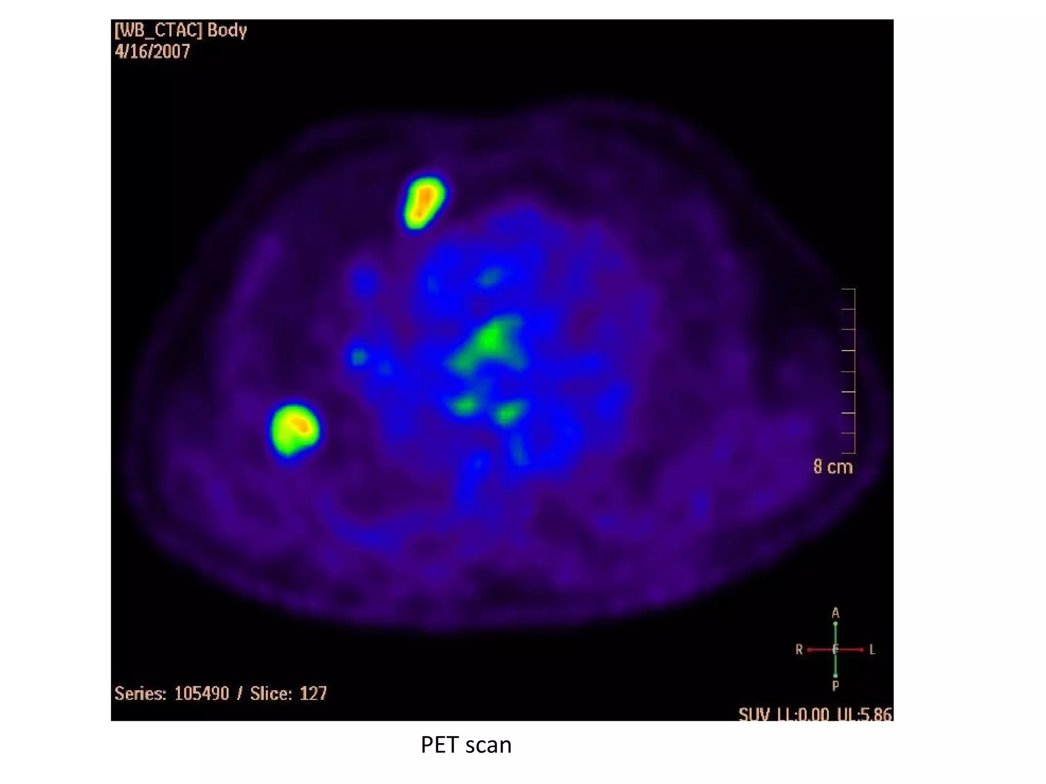 Pet presentation, positron emission tomography | PPT