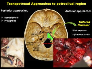 Petrosal%20approach%201012.pptx: Tailored approach | PPTX