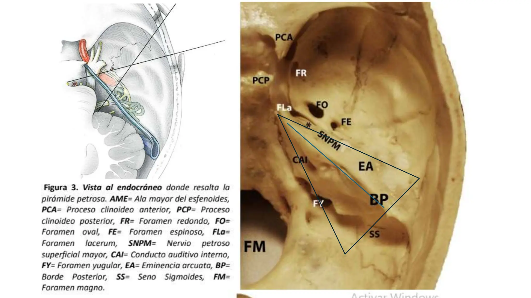 PETROSECTOMIA ANTERIOR, abordaje neuroquirurgico de fosa media.pptx
