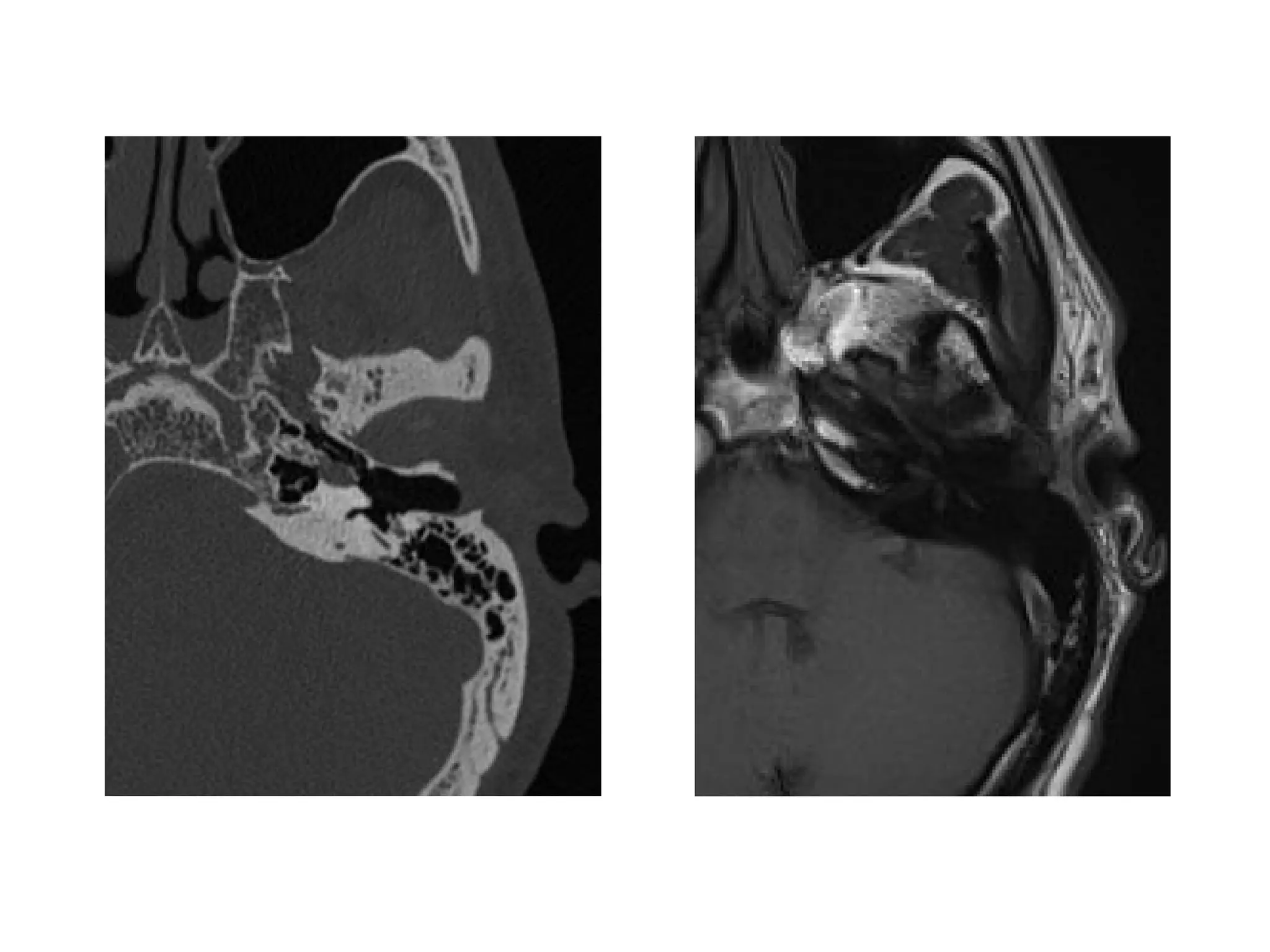 Petrous apex and skull base | PPT