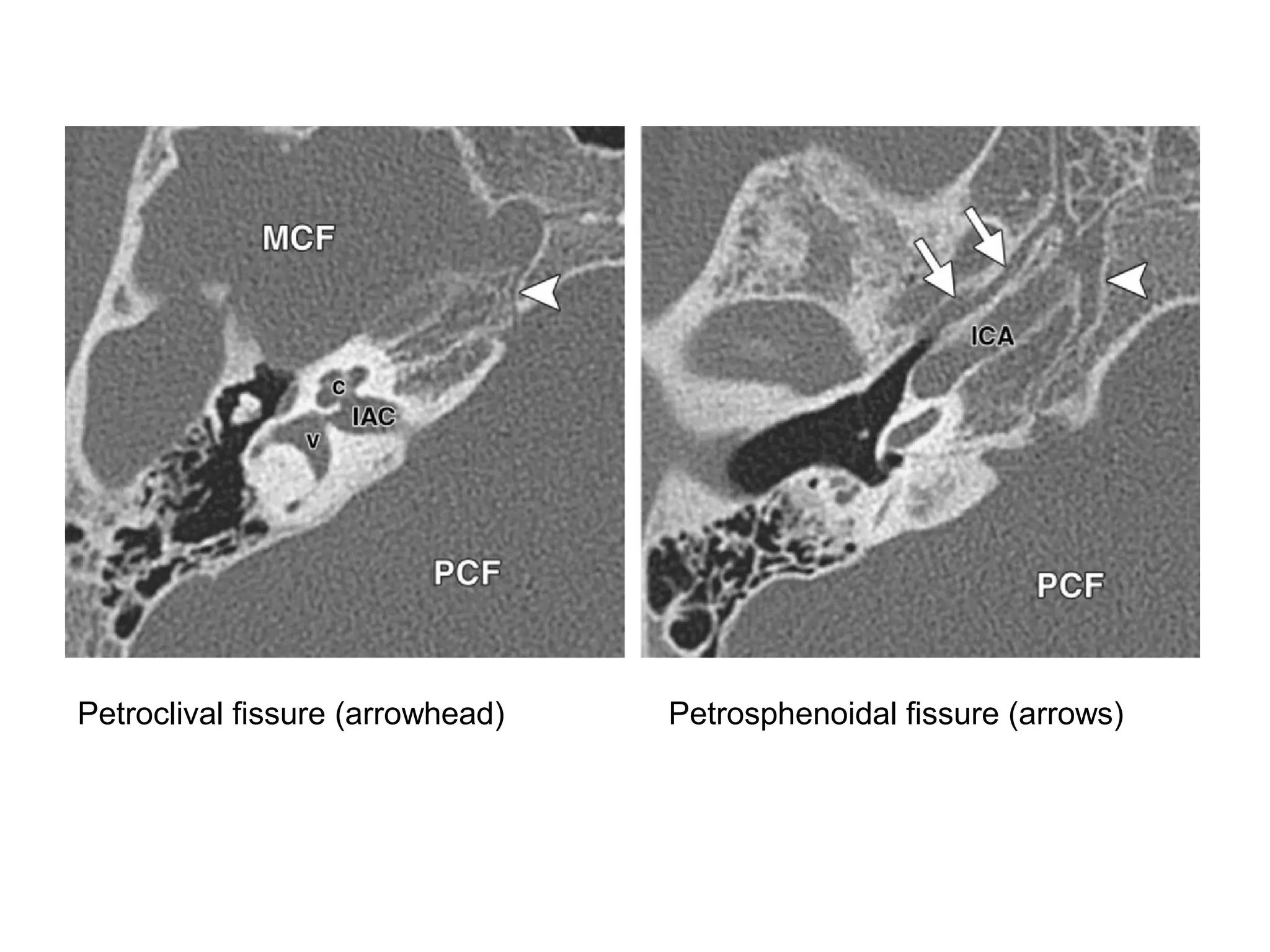 Petrous apex and skull base | PPT