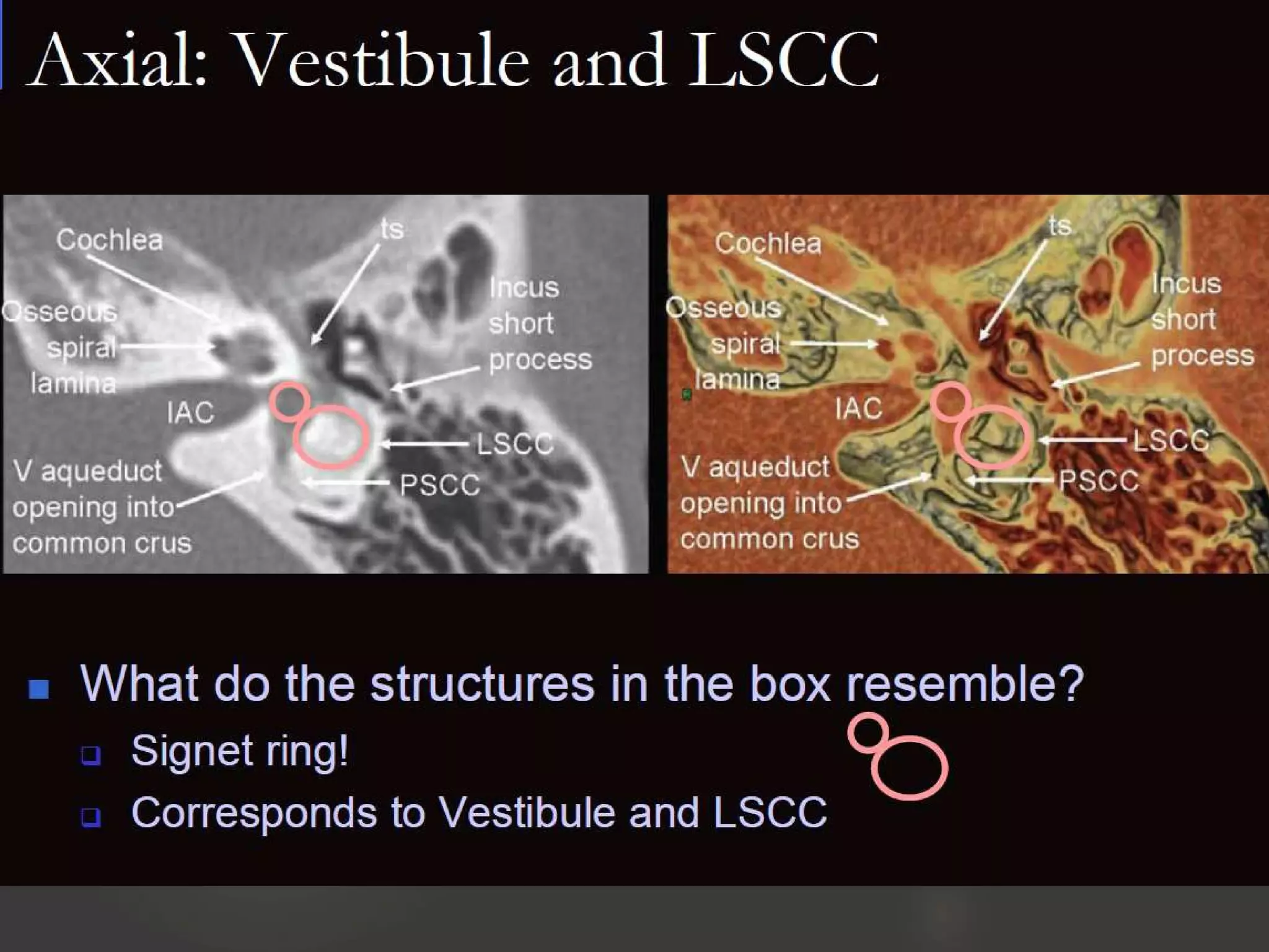 Temporal bone Radiologic anatomy.. In depth | PPT
