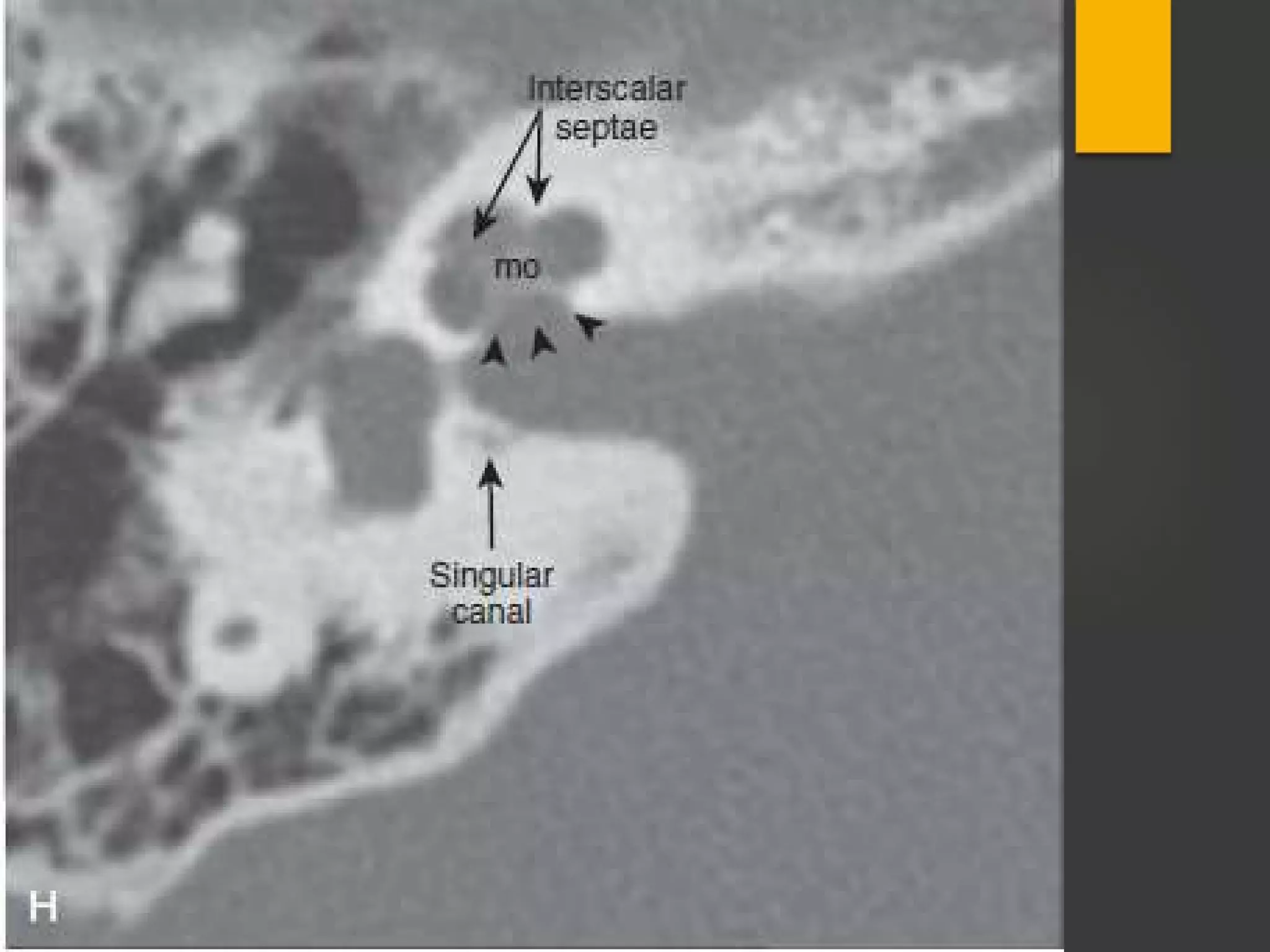Temporal bone Radiologic anatomy.. In depth | PPT