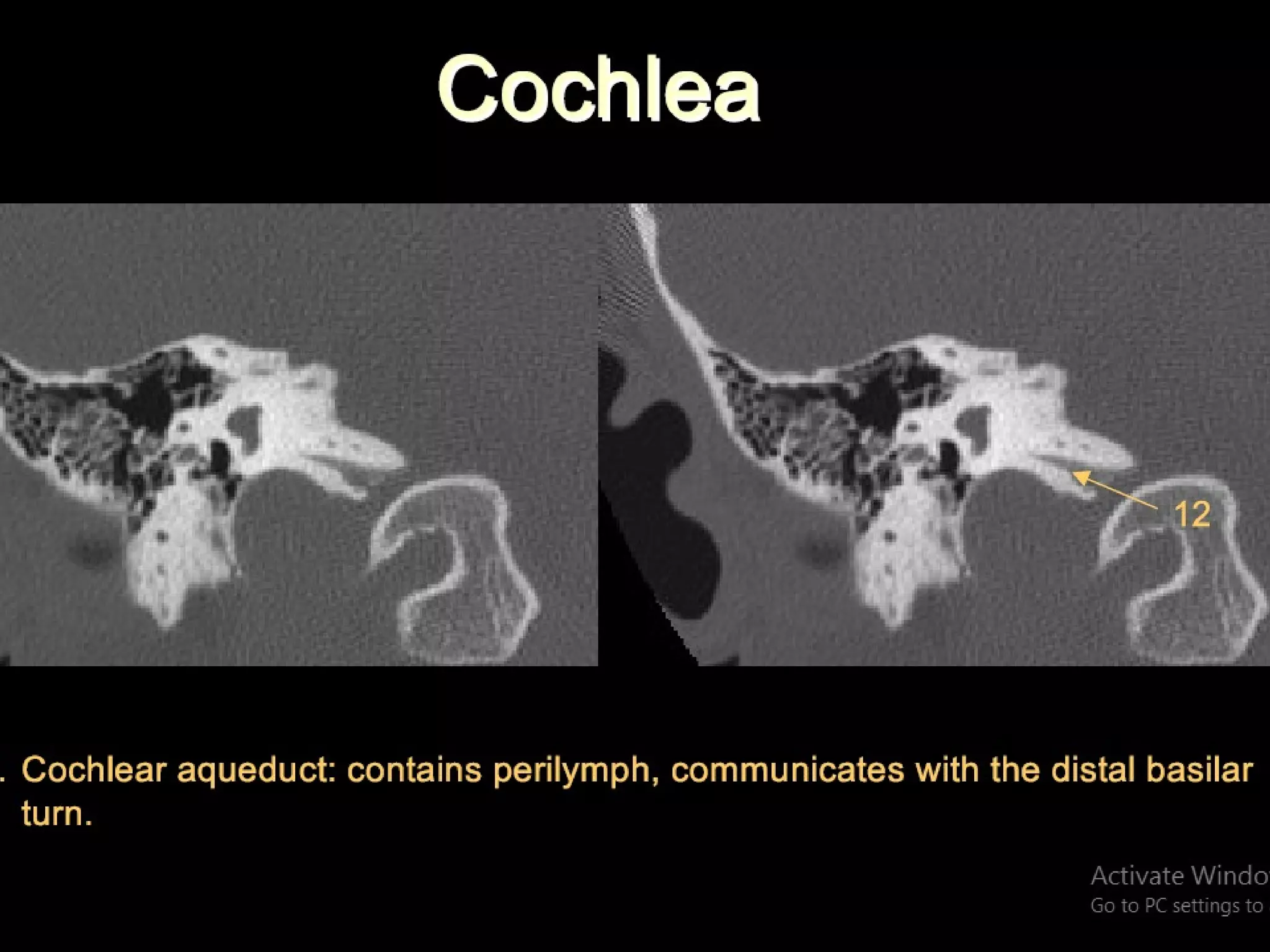Temporal bone Radiologic anatomy.. In depth | PPT