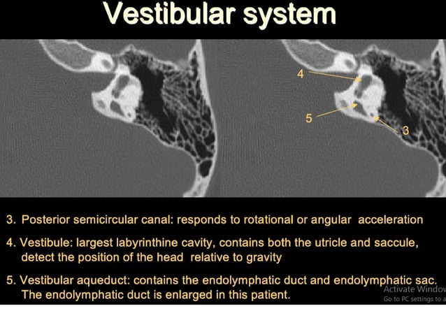 Temporal bone Radiologic anatomy.. In depth | PPT
