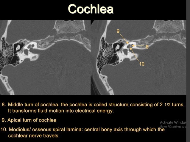 Temporal bone Radiologic anatomy.. In depth | PPT