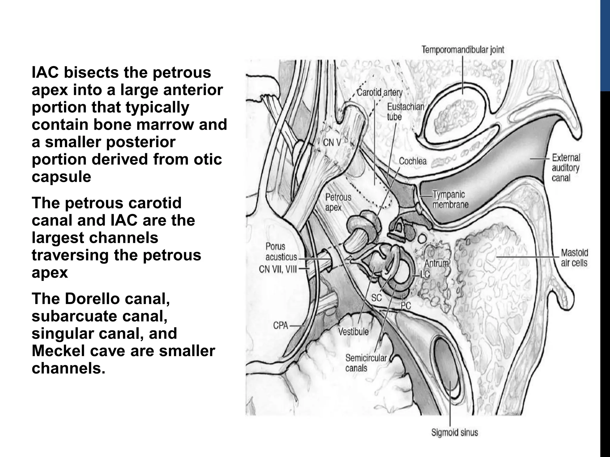 Petrous cholesteatoma sample | PPTX
