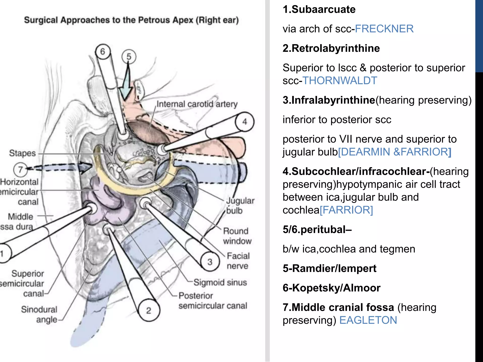 Petrous cholesteatoma sample | PPTX