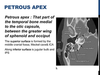 Petrous cholesteatoma sample | PPTX