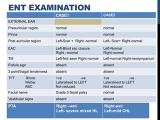 Petrous cholesteatoma sample | PPTX