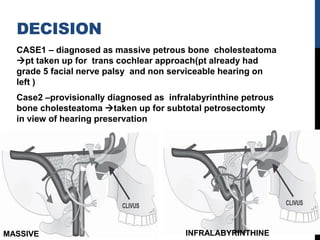 Petrous cholesteatoma sample | PPTX