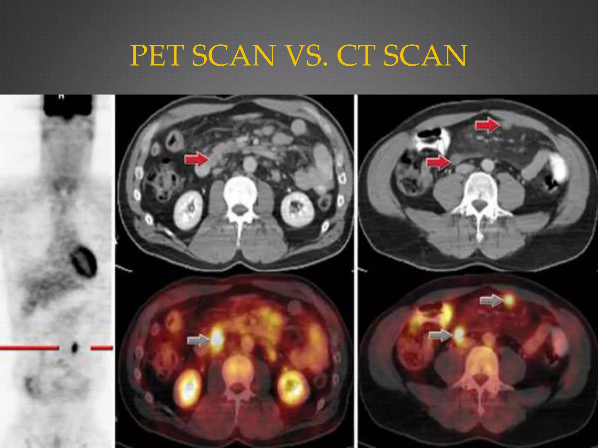 Positron Emissions Tomography (PET SCAN) | PPTX
