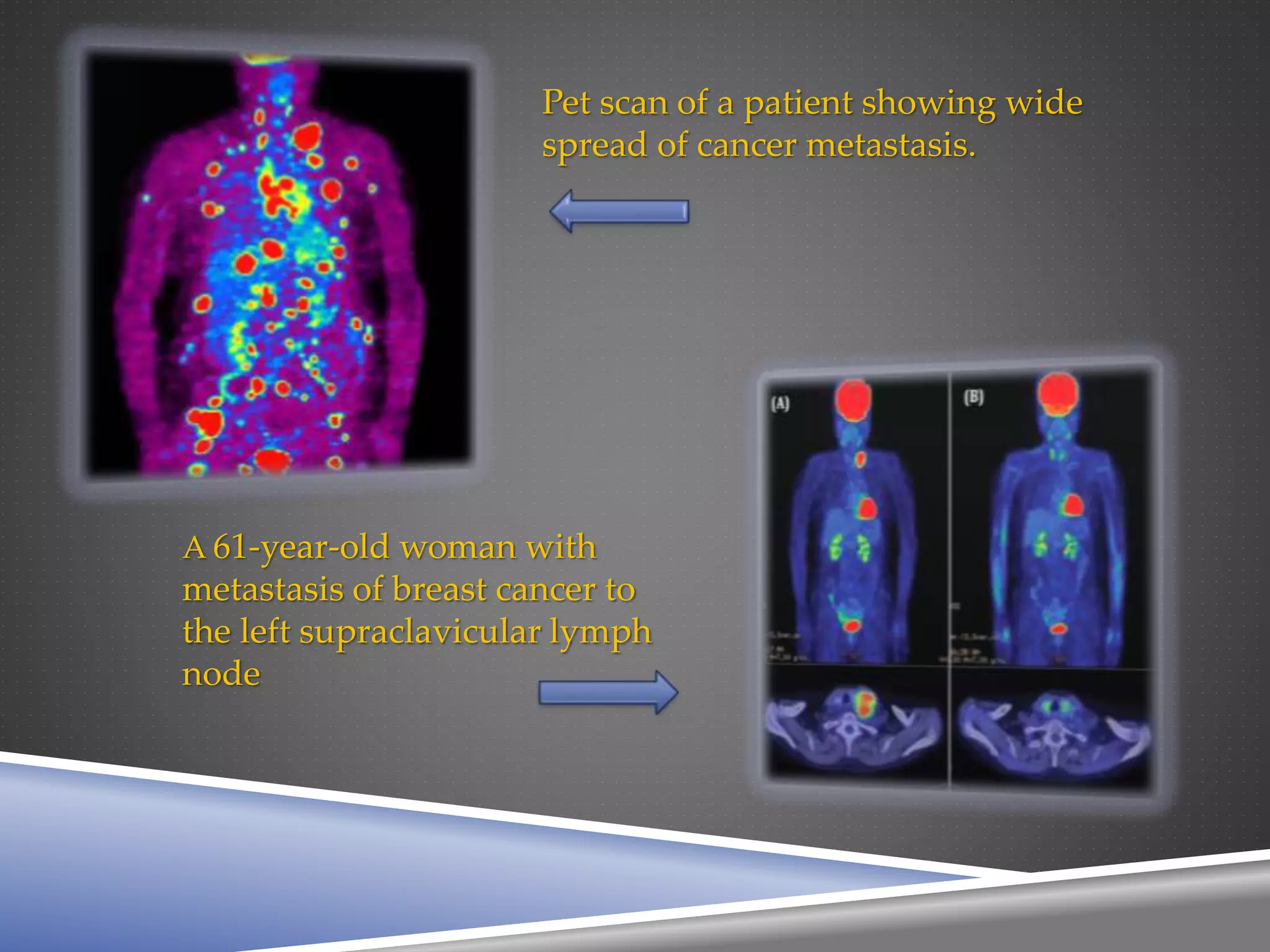 Positron Emissions Tomography (PET SCAN) | PPTX