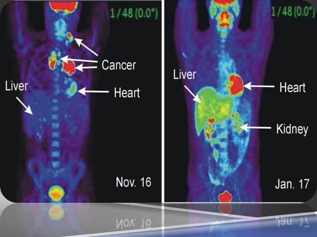 Positron Emissions Tomography (PET SCAN) | PPTX