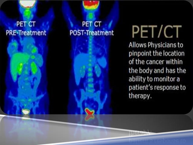 Positron Emissions Tomography (PET SCAN) | PPTX