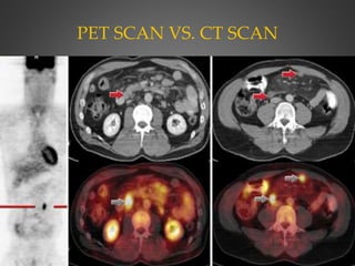 Positron Emissions Tomography (PET SCAN) | PPTX