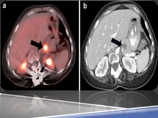 Positron Emissions Tomography (PET SCAN) | PPTX