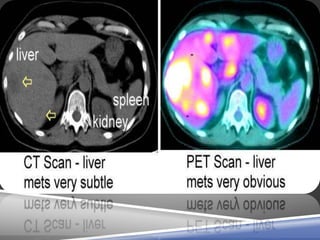 Positron Emissions Tomography (PET SCAN) | PPTX