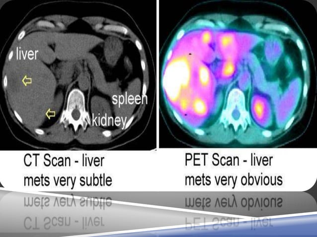 Positron Emissions Tomography (PET SCAN) | PPTX