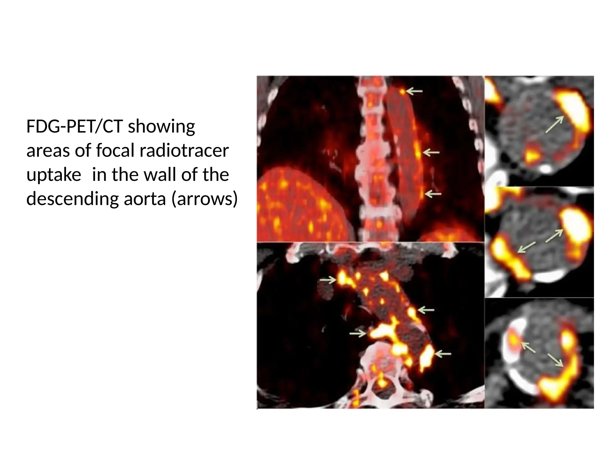 PET SCAN in the management of cardiovascular | PPTX