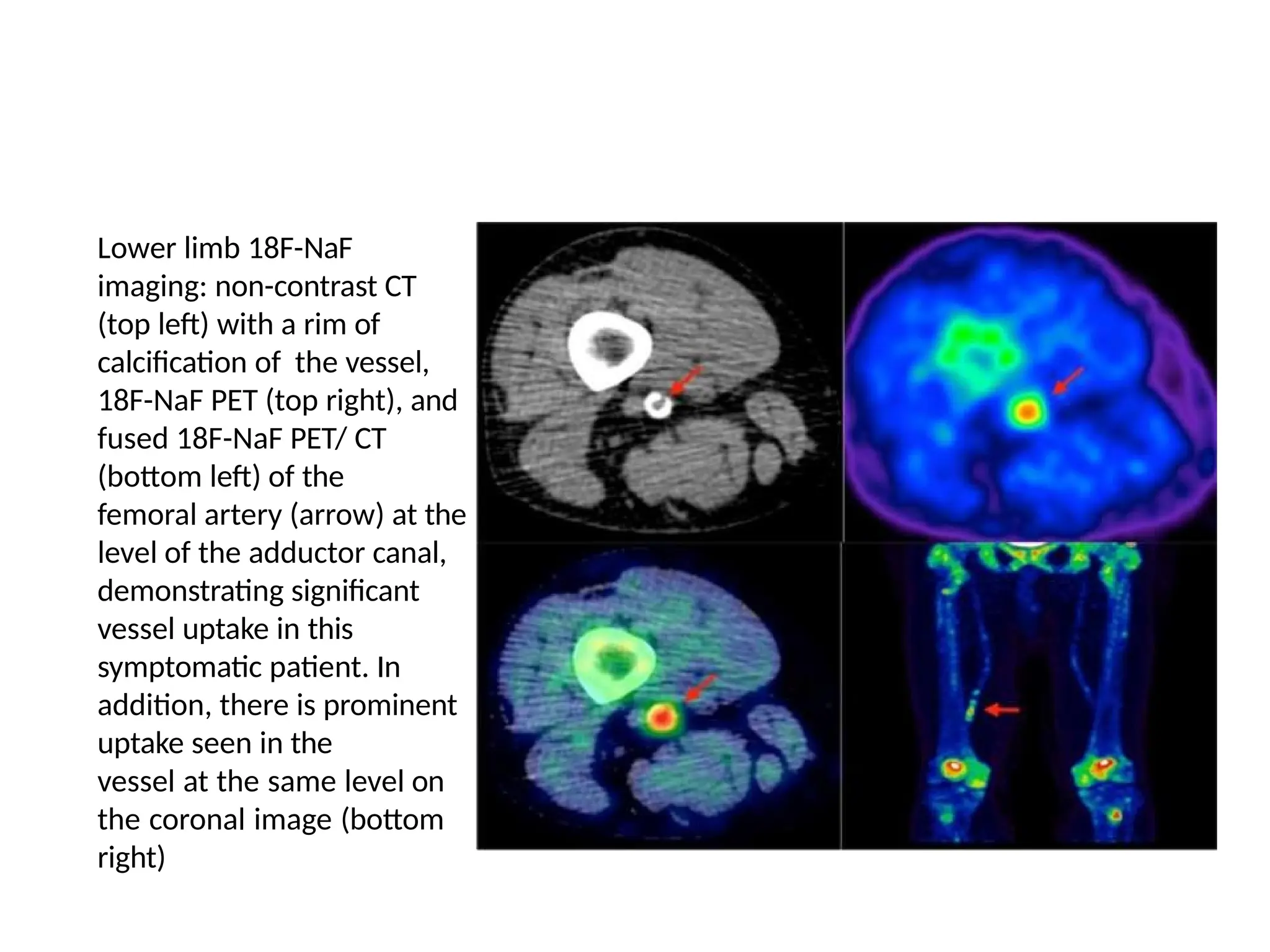 PET SCAN in the management of cardiovascular | PPTX