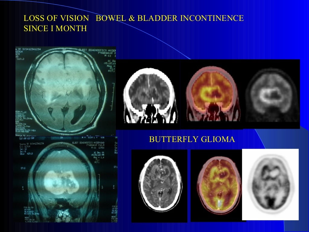 Principles and application of PET CT & PET MR Principles and application of PET CT & PET MR