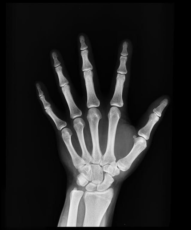 Hand injuries can be mild but it can be worst too. | PDF