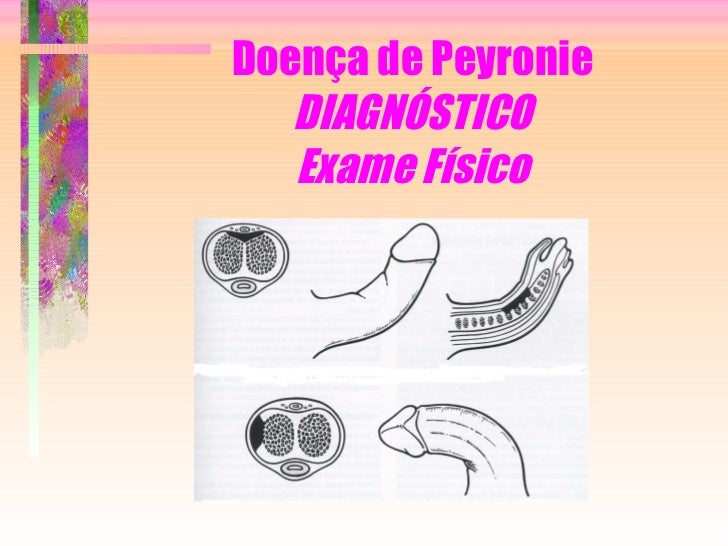 Doença de Peyronie Tratamento Cirúrgico