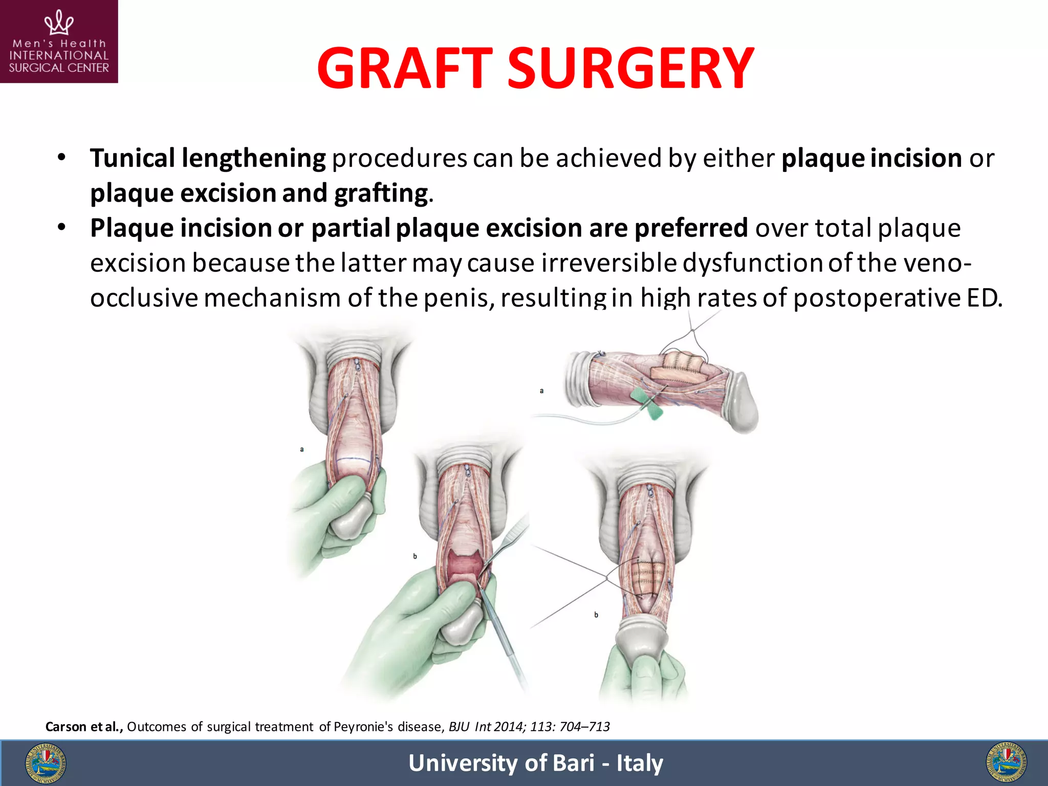 Peyronie S Disease A Tailored Surgical Procedure For Every Patient Pdf