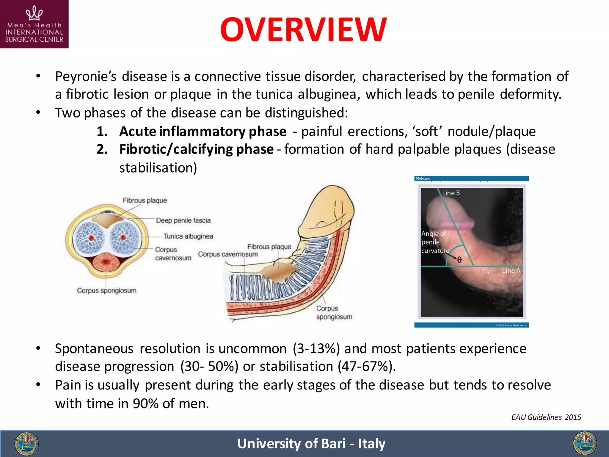 Peyronie's Disease: a tailored surgical procedure for every patient | PDF