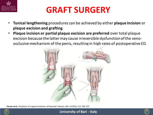Peyronie's Disease: a tailored surgical procedure for every patient | PPT
