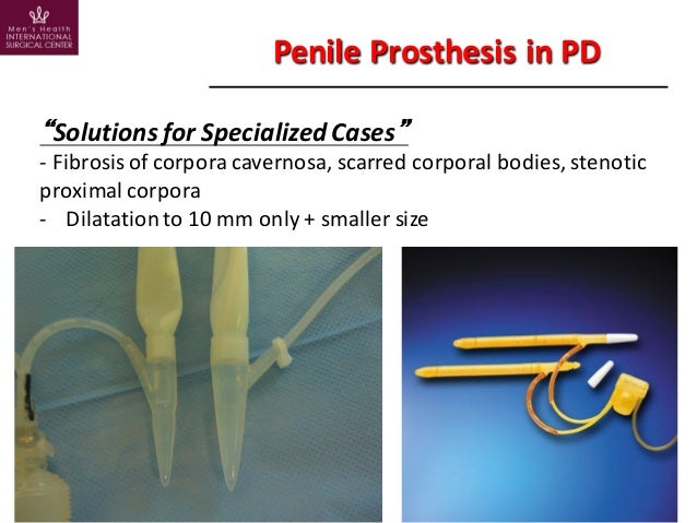Peyronies Disease A Tailored Surgical Procedure For Every Patient