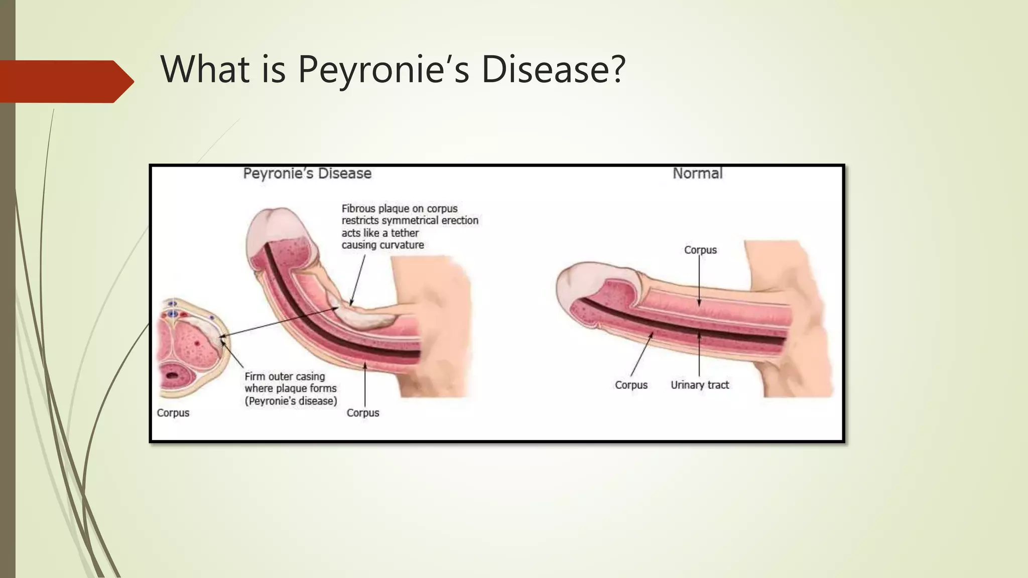Peyronie’s disease01 | PPTX
