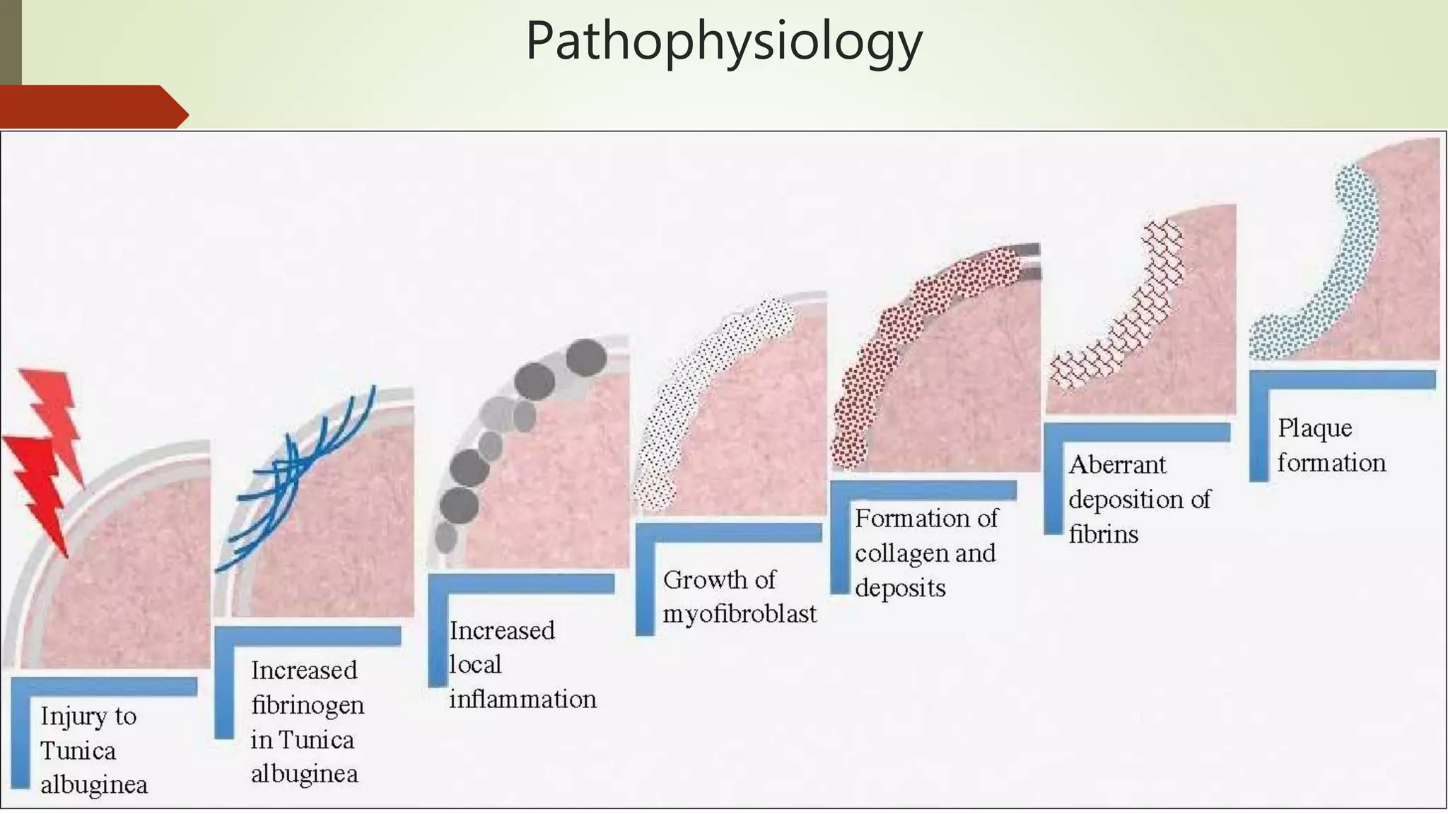Peyronie’s disease01 | PPTX