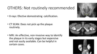 Peyronies disease: diagnostic | PPTX