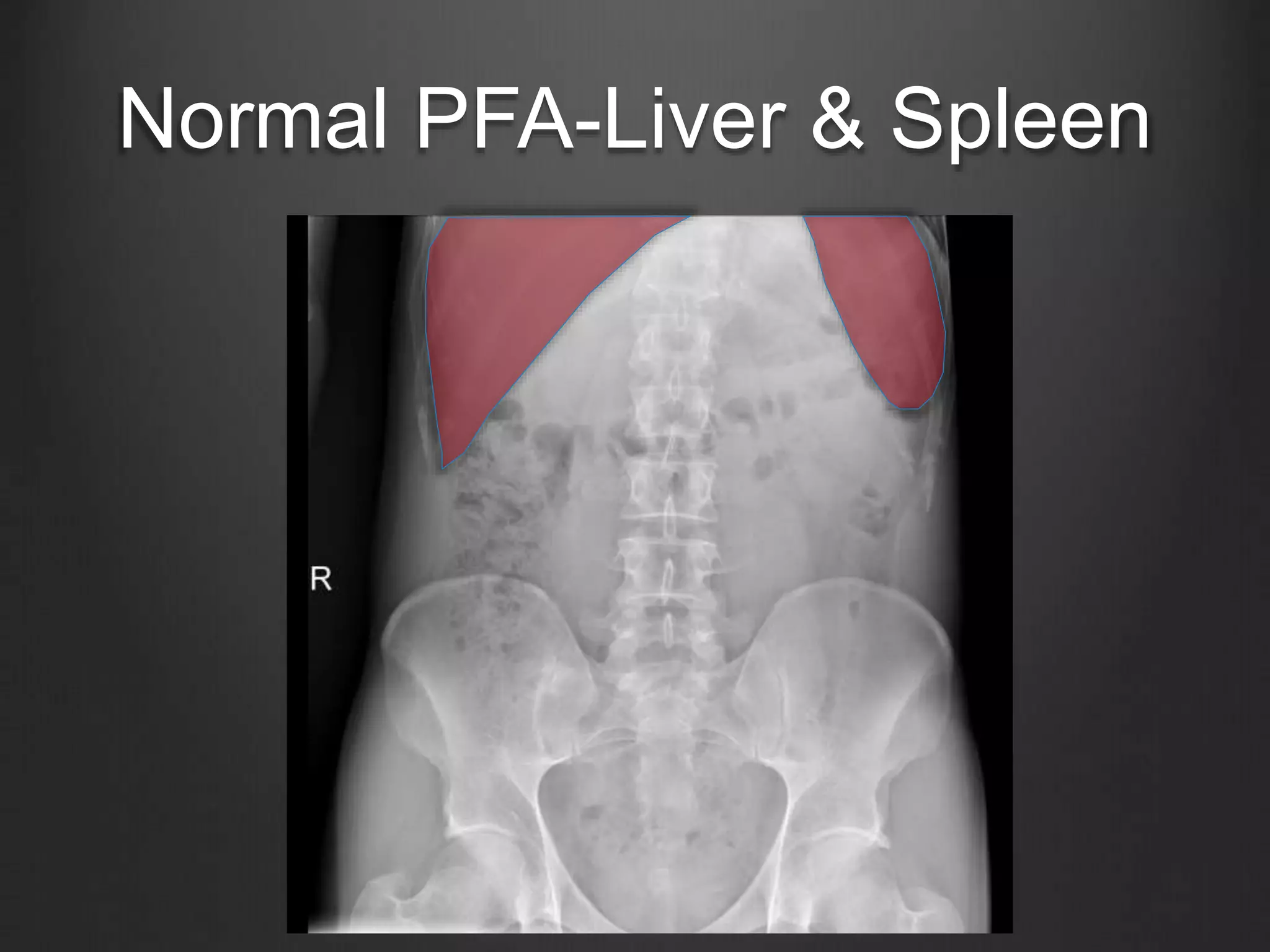 Approach to PFA Interpretation | PPTX