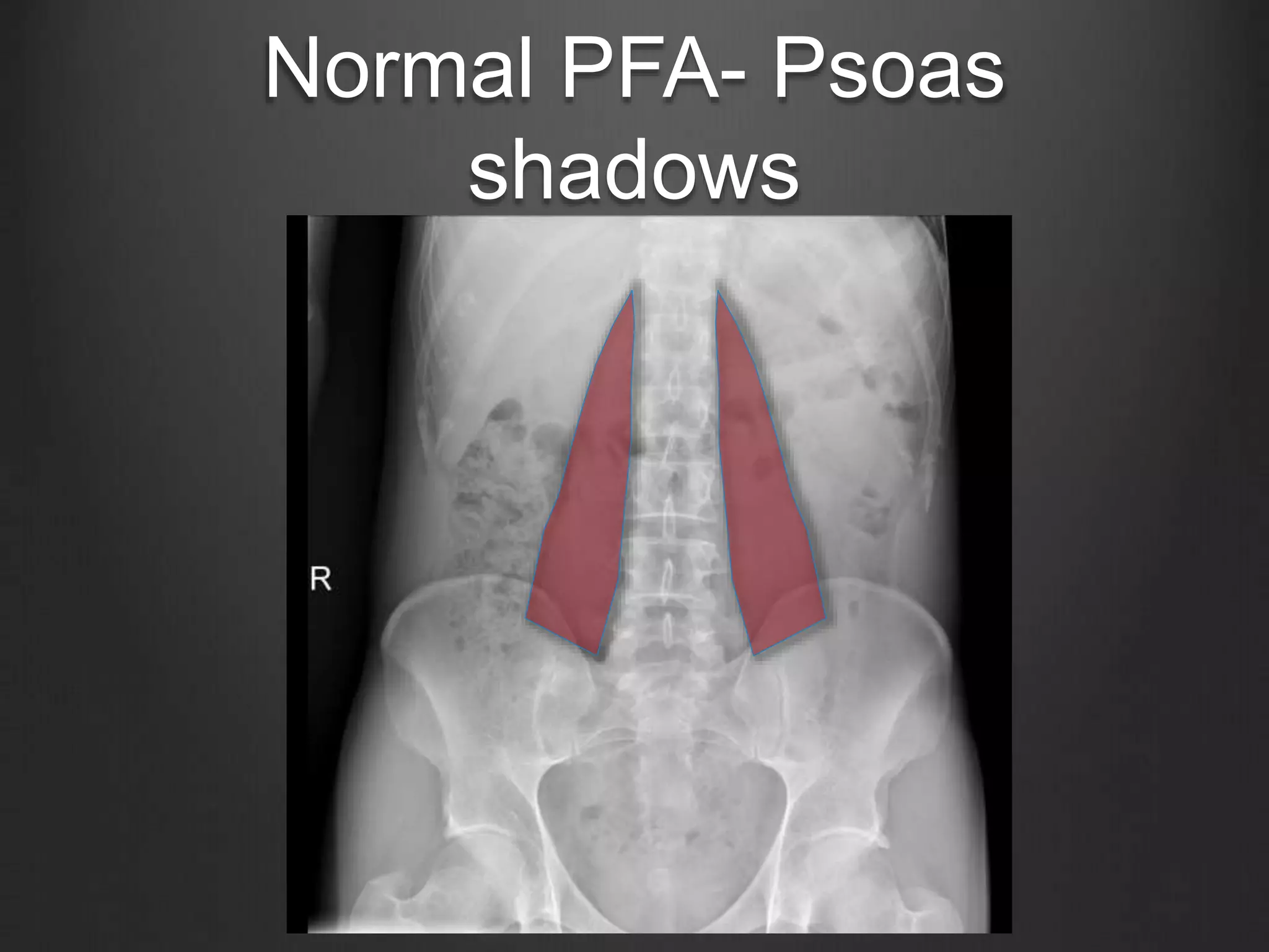 Approach to PFA Interpretation | PPTX
