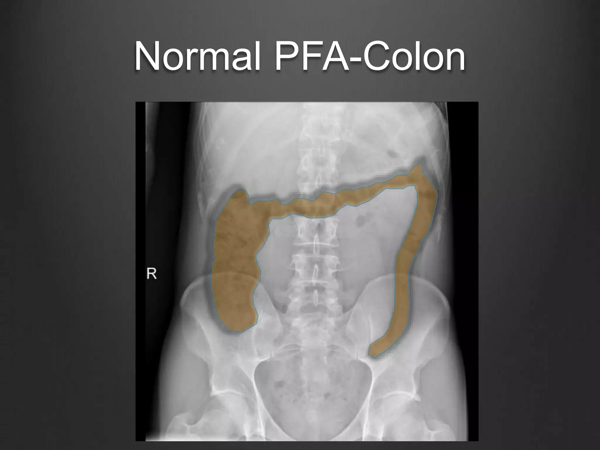 Approach to PFA Interpretation | PPTX