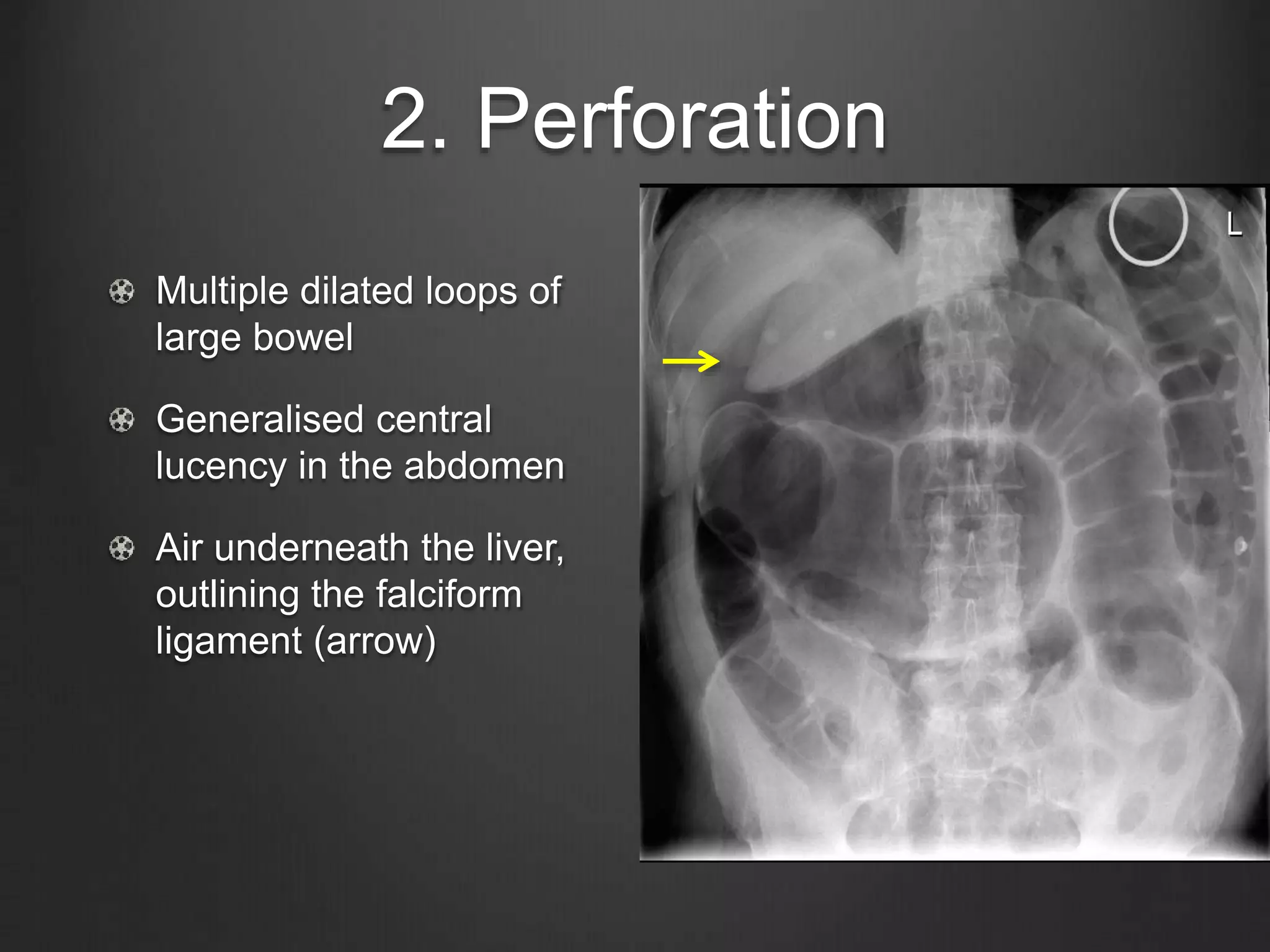 Approach to PFA Interpretation | PPTX