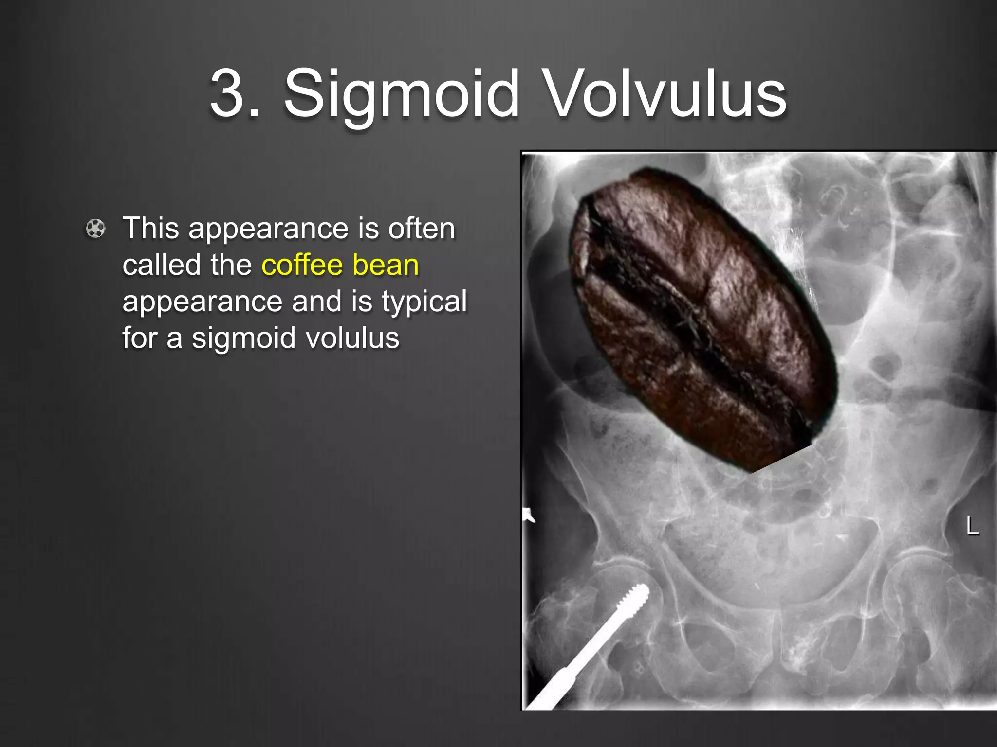 Approach to PFA Interpretation | PPTX
