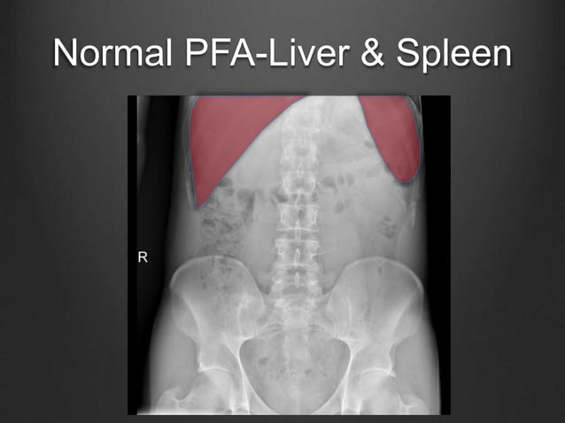 Approach to PFA Interpretation | PPTX | Digestive Disorders | Diseases ...