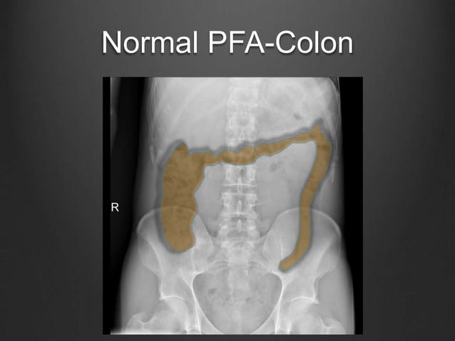 Approach to PFA Interpretation | PPTX | Digestive Disorders | Diseases ...