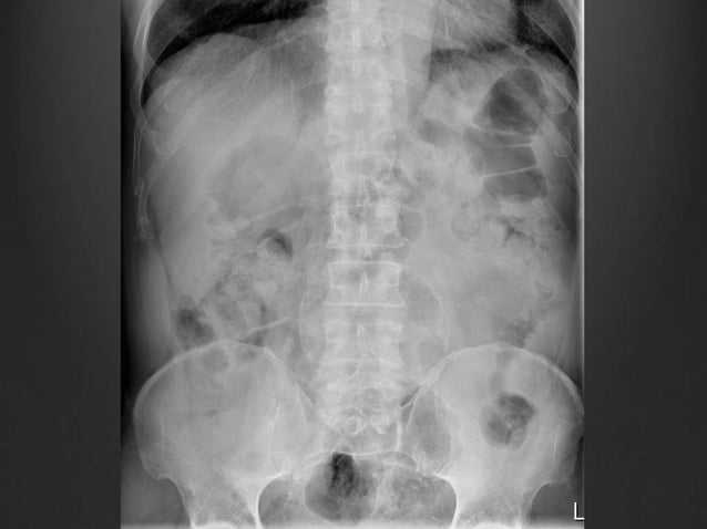 Approach to PFA Interpretation | PPTX | Digestive Disorders | Diseases and Conditions