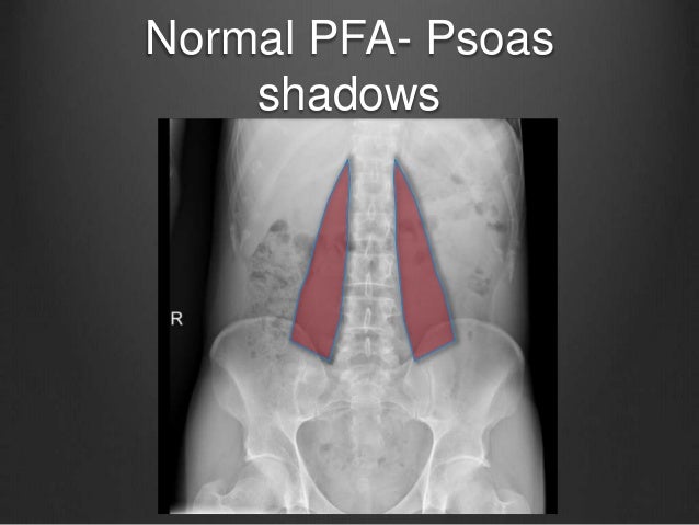 Approach to PFA Interpretation