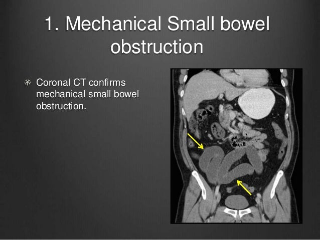 Approach to PFA Interpretation
