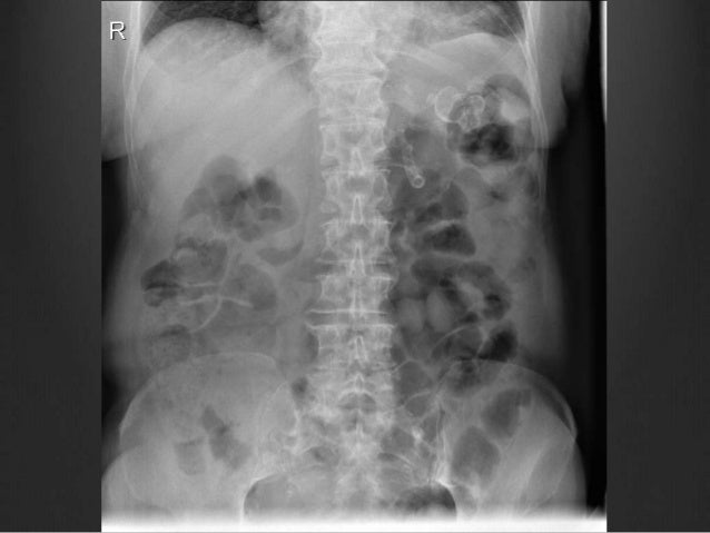 Approach to PFA Interpretation
