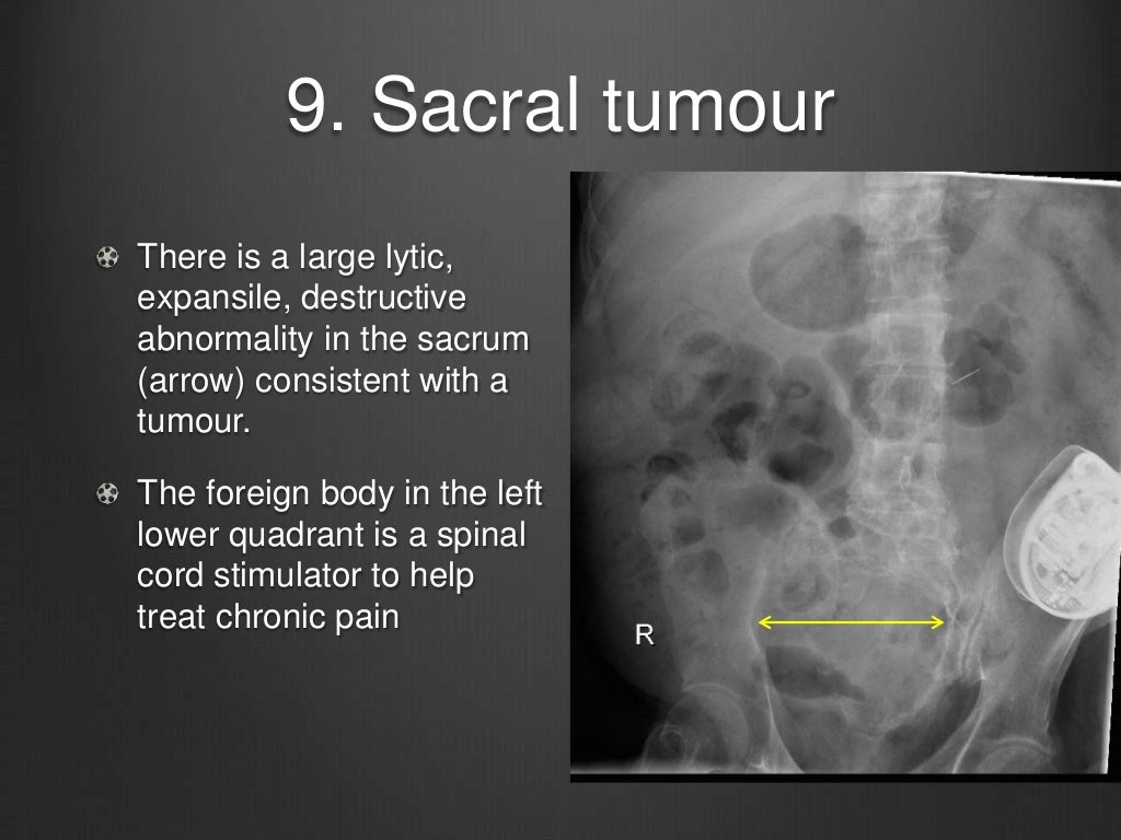 Approach to PFA Interpretation