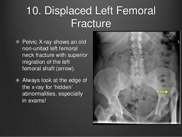 Approach to PFA Interpretation