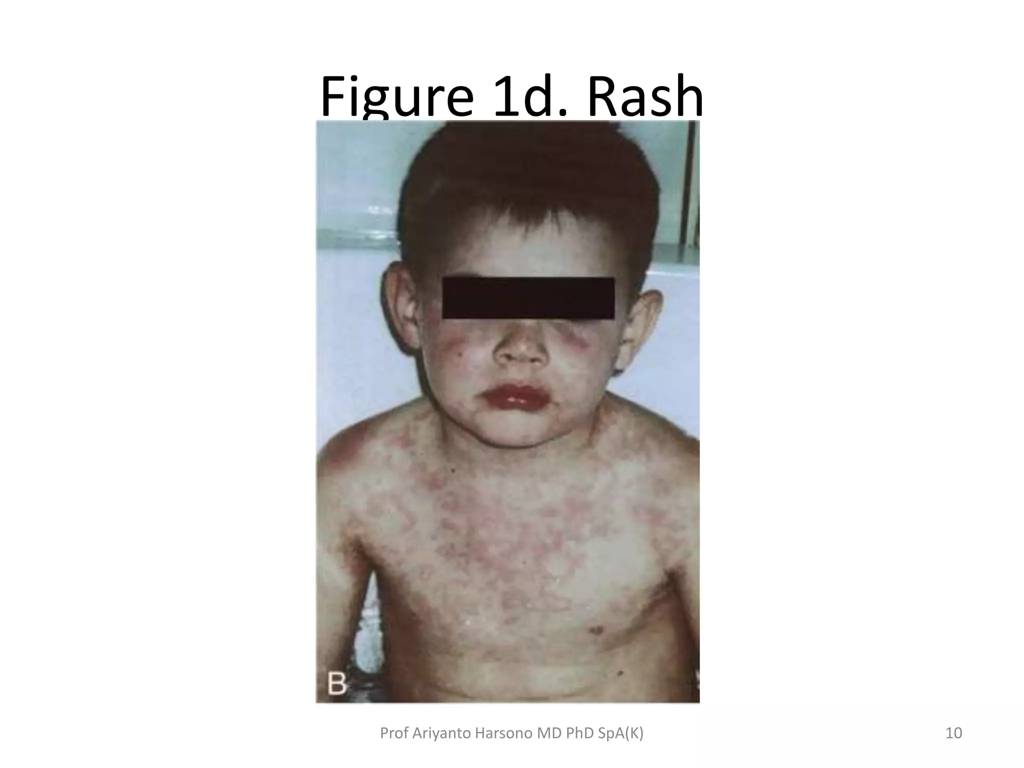 PFAPA syndrome and its related diseases | PPTX