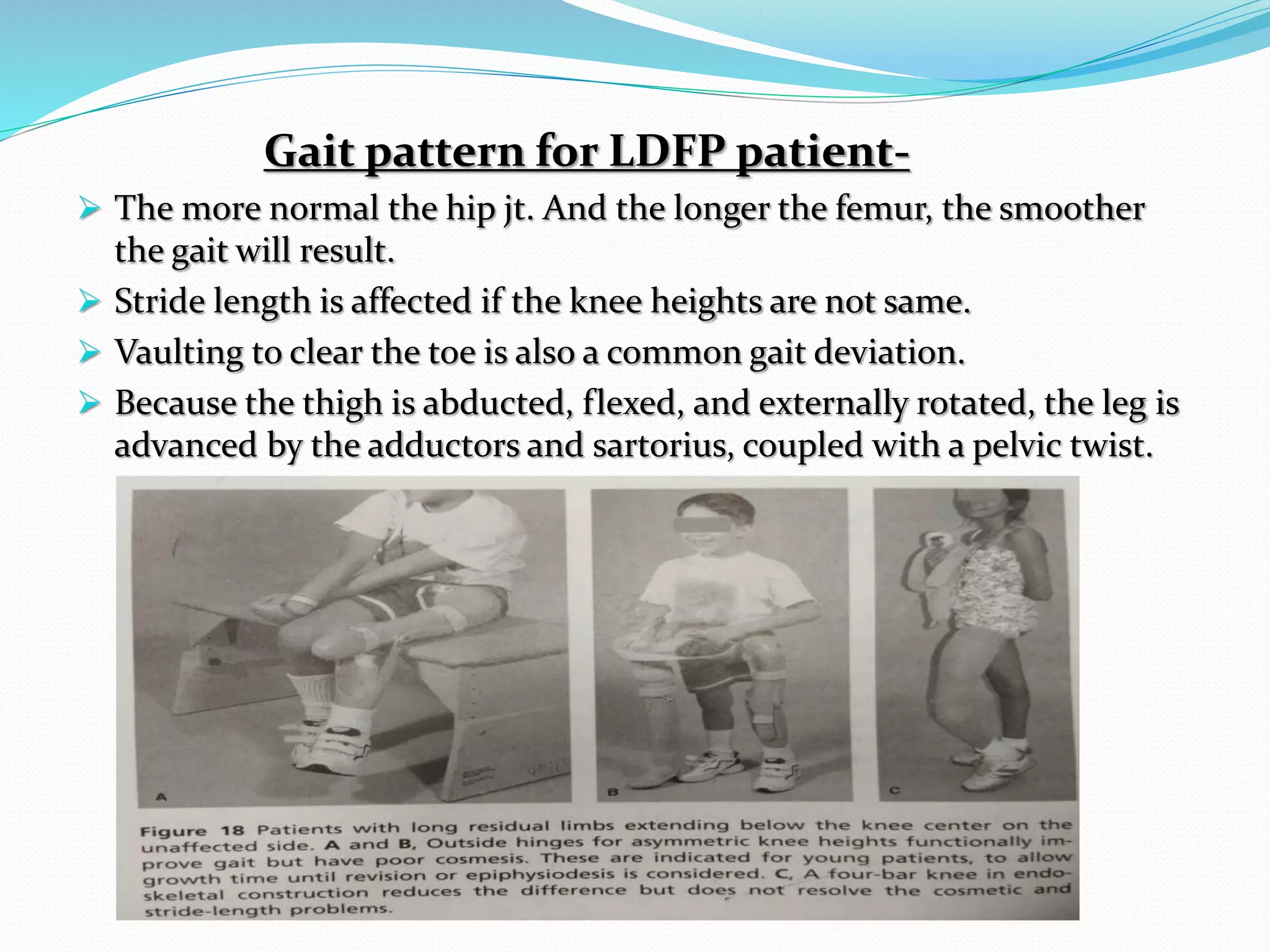 PFFD [proximal femoral focal deficiency] | PPTX